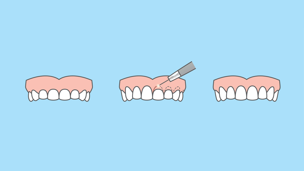 Gingivectomy Explained: Procedure Steps, Benefits, and Recovery - Los ...