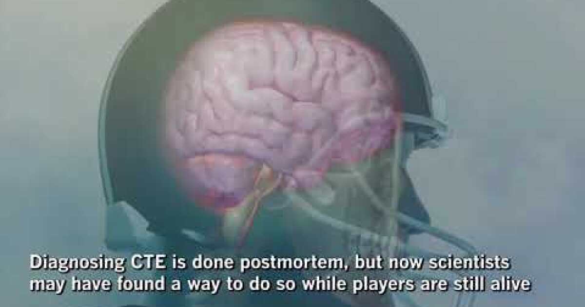 Scientists May Have Found A Way To Diagnose Cte In Football Players While Theyre Still Alive
