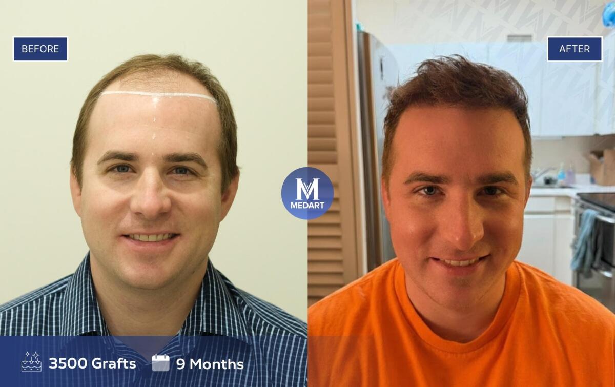Hair Transplant in Turkey: 2026 Cost & Clinics - Los Angeles Times